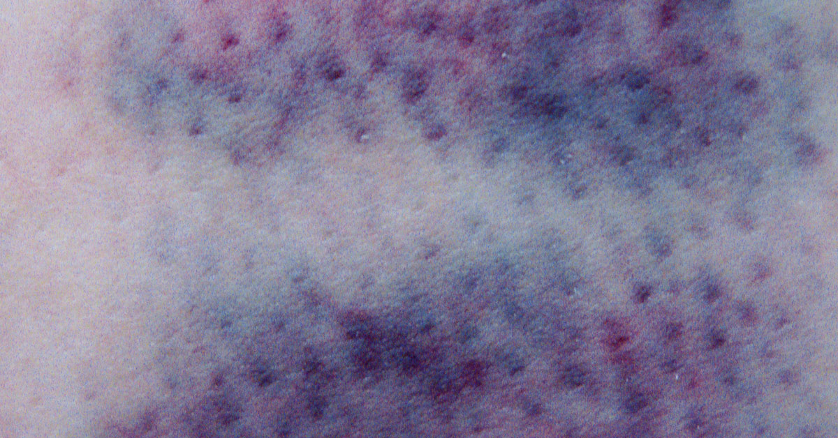 CABINET / Inventory / A Taxonomy of Bruises